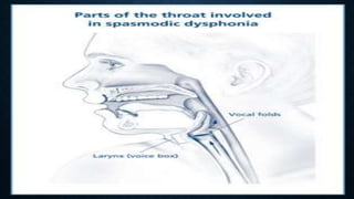 Spasmodic dysphonia | PPT