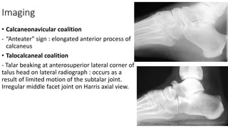 Spastic flat foot maitreya patil | PPT
