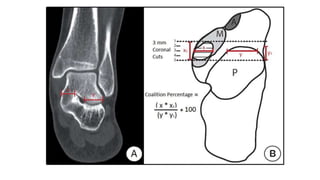 Spastic flat foot maitreya patil | PPT