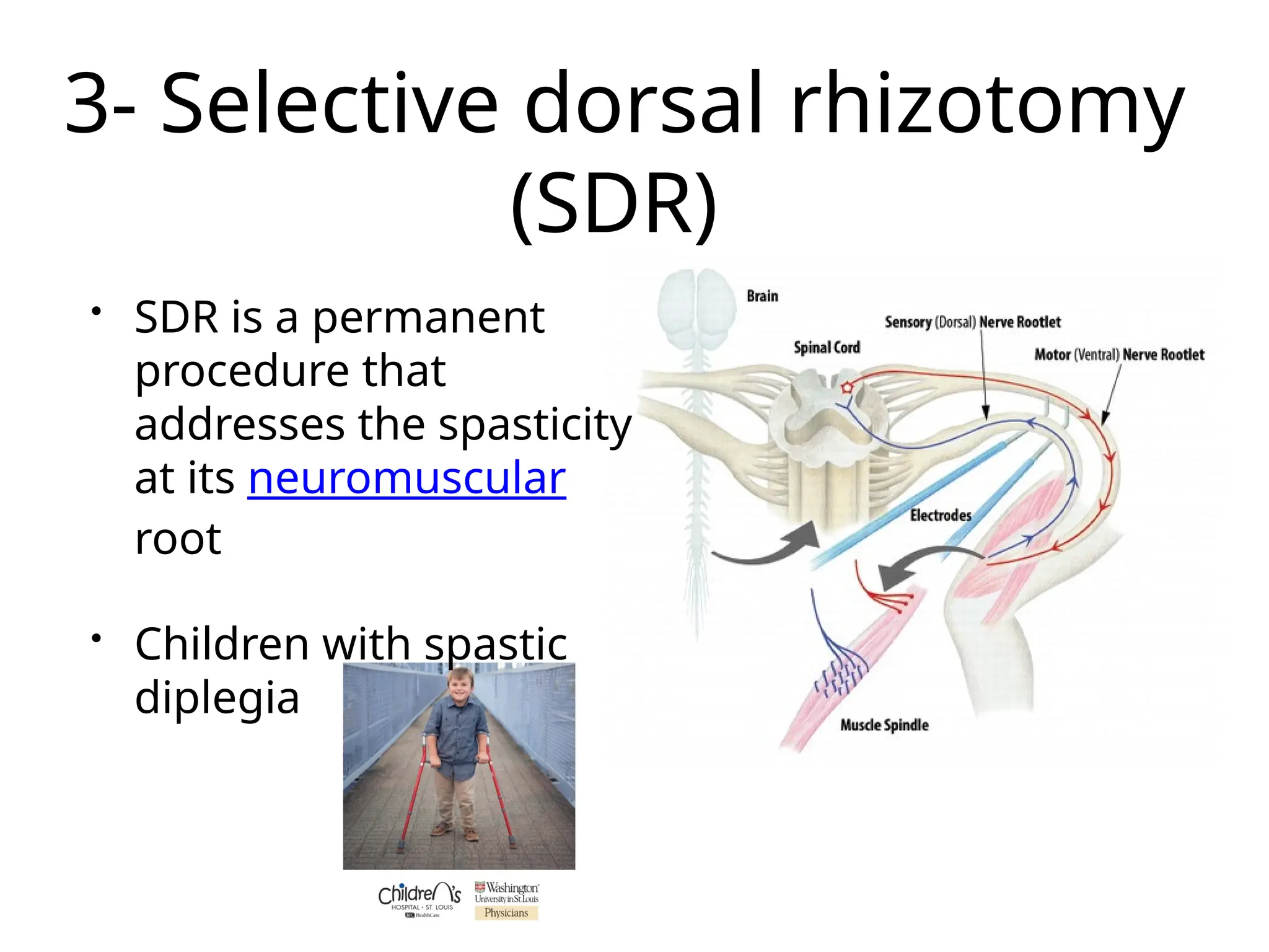 Spasticity from clinical neurology to management | PPT