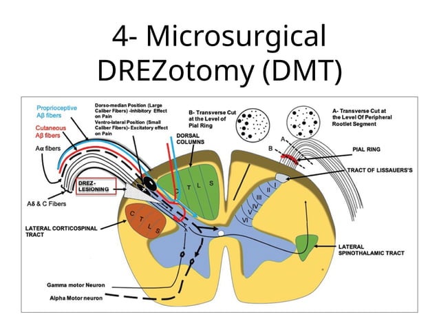 Spasticity from clinical neurology to management | PPT