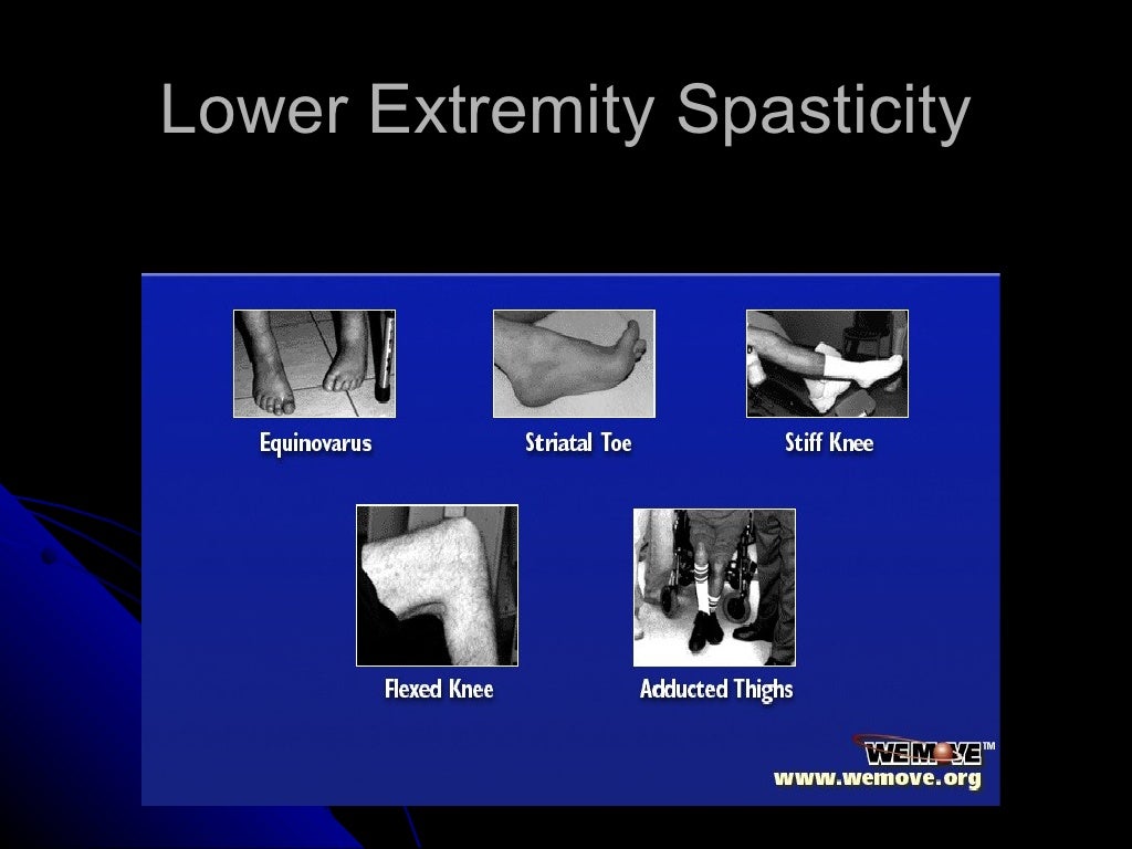 NurseReview.Org - Spasticity After Stroke