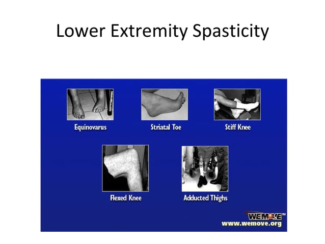 Spasticity After Stroke | PPT