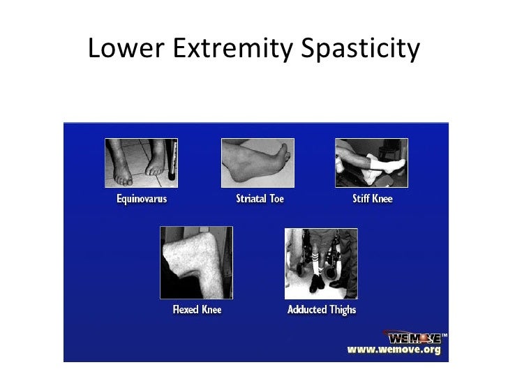 Spasticity After Stroke
