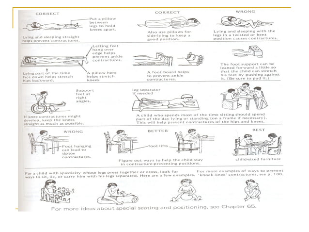 Spasticity management in Cerebral Palsy | PPT