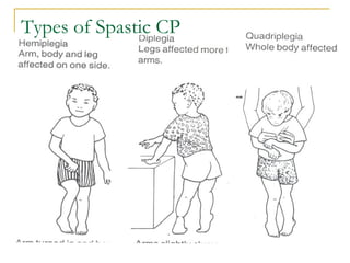 Spastic Cerebral Palsy