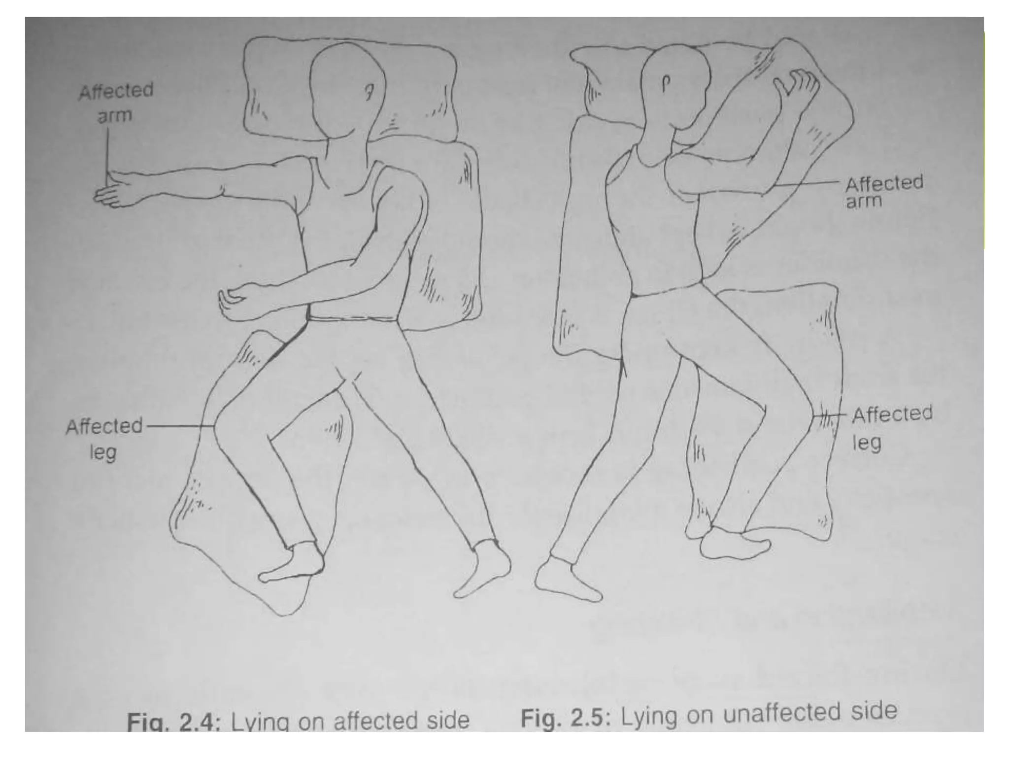 Spasticity management | PPTX