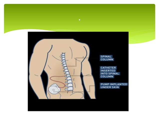 Spasticity management | PPTX | Physical Therapy | Wellness