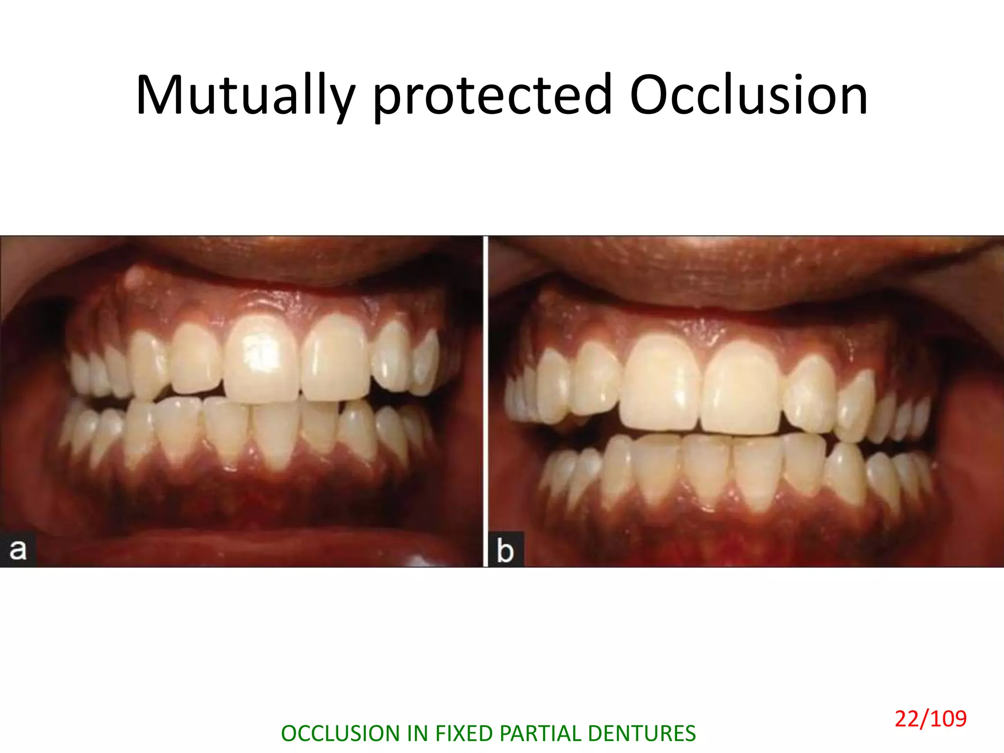 Occlusion In Fixed Partial Denture | PPTX