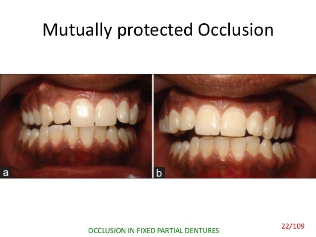 Occlusion In Fixed Partial Denture
