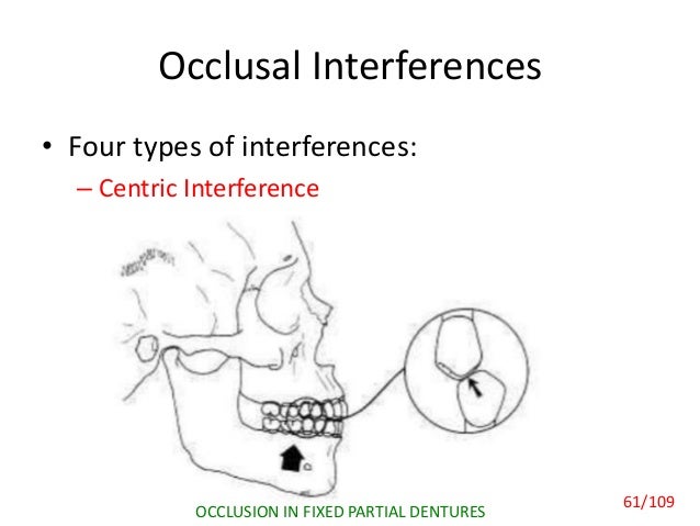 Occlusion In Fixed Partial Denture
