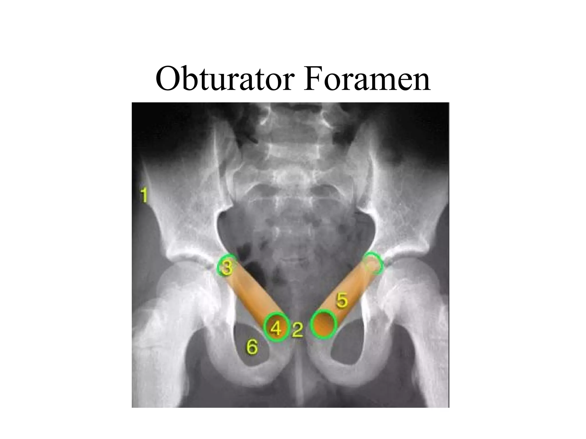 Special Considerations: Obturator, Femoral and Scrotal Hernias | PPT