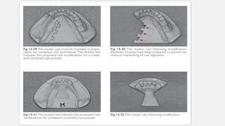 special impression procedures for tooth- tissue supported RPD.pptx