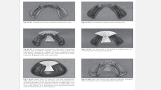 special impression procedures for tooth- tissue supported RPD.pptx