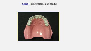 special impression procedures for tooth- tissue supported RPD.pptx