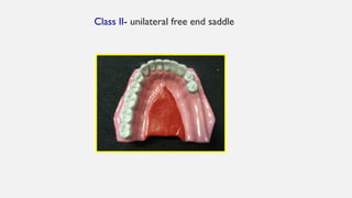 special impression procedures for tooth- tissue supported RPD.pptx