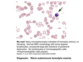 Specialist presentation 3 26 hemolytic anemia | PPT