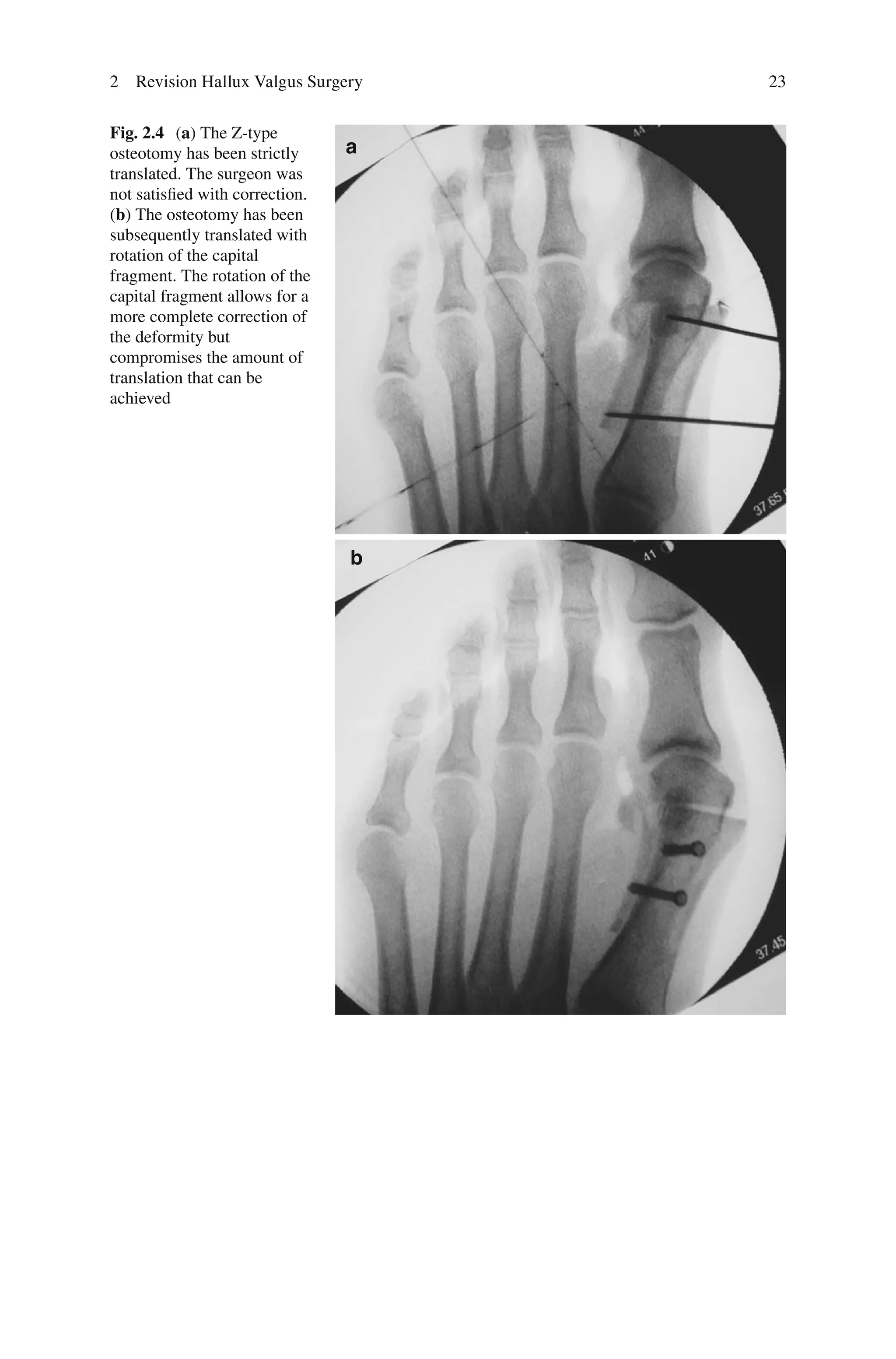 Special procedures in foot and ankle surgery | PDF