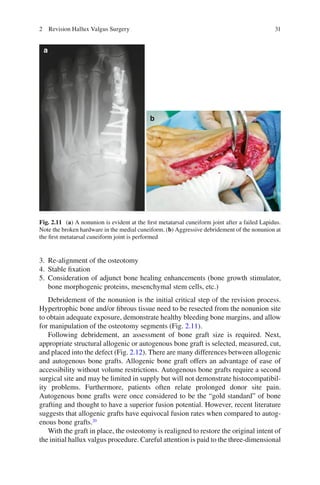 Special procedures in foot and ankle surgery | PDF