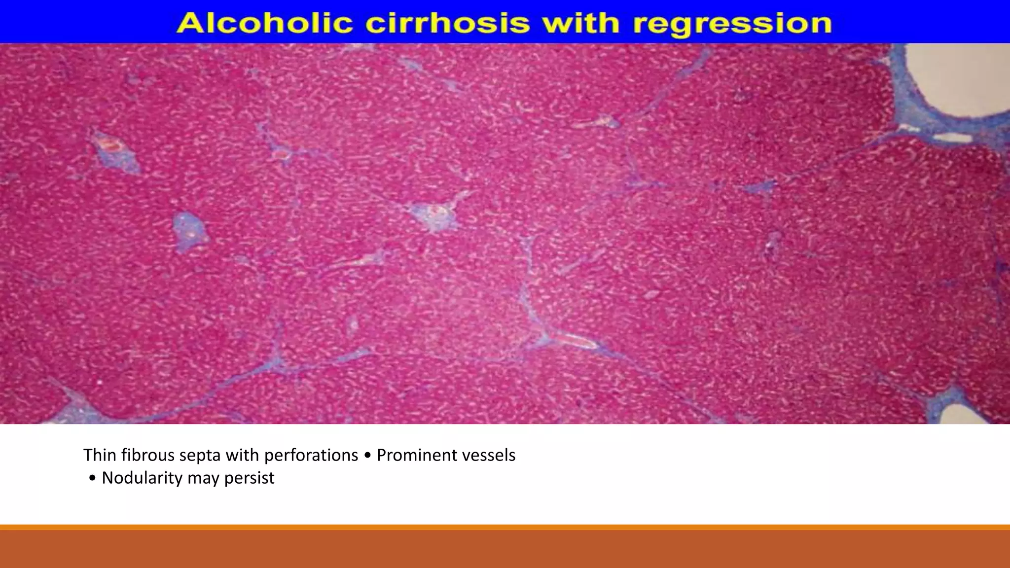 SPECIAL STAINS USED IN DIAGNOSING LIVER PATHOLOGY | PPTX