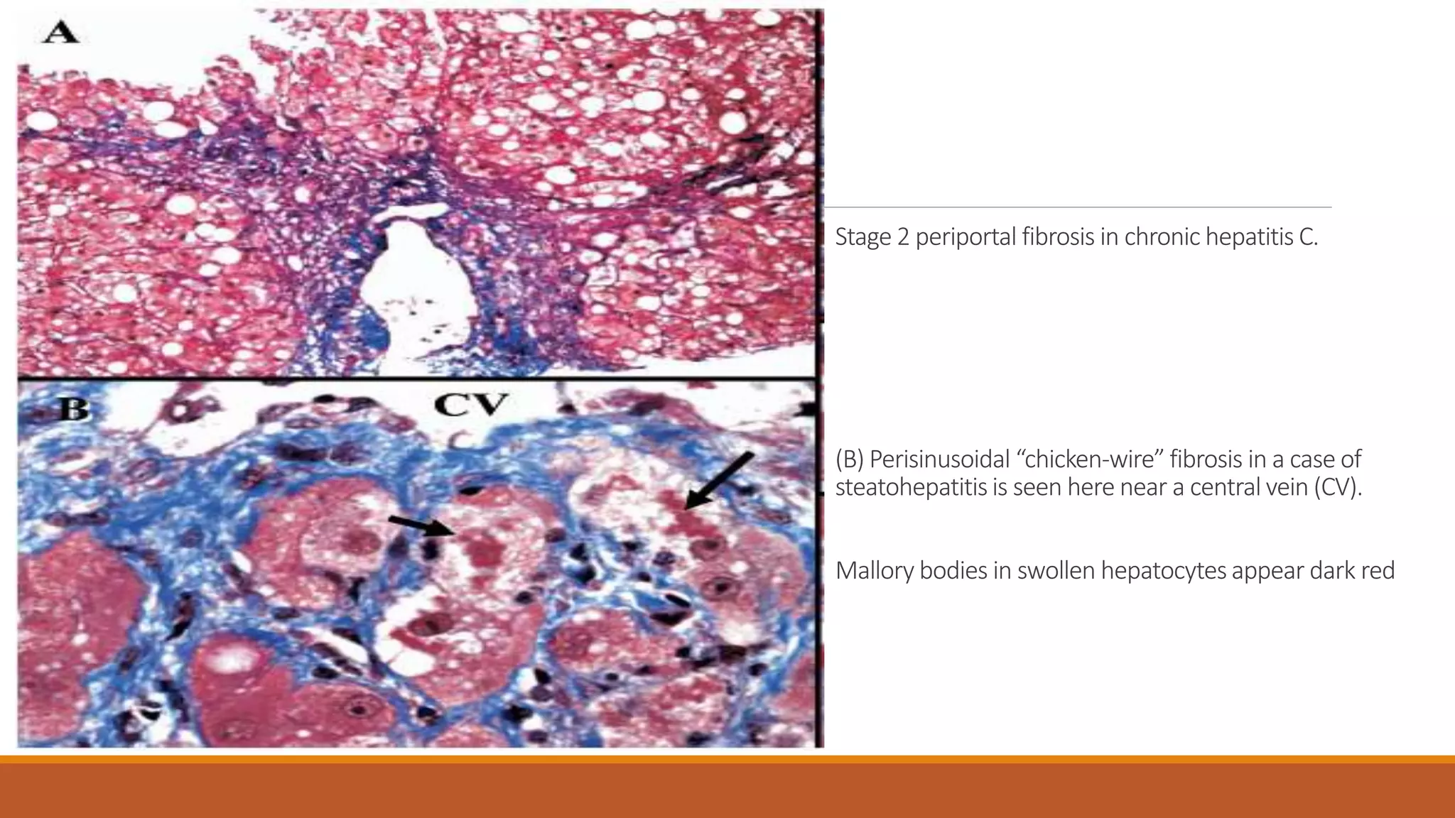 SPECIAL STAINS USED IN DIAGNOSING LIVER PATHOLOGY | PPTX