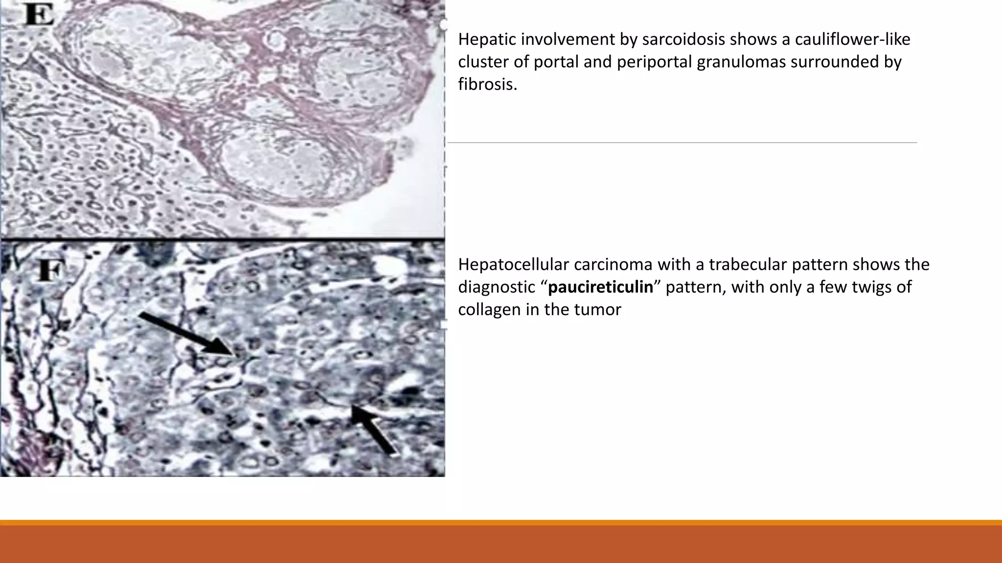 SPECIAL STAINS USED IN DIAGNOSING LIVER PATHOLOGY | PPTX