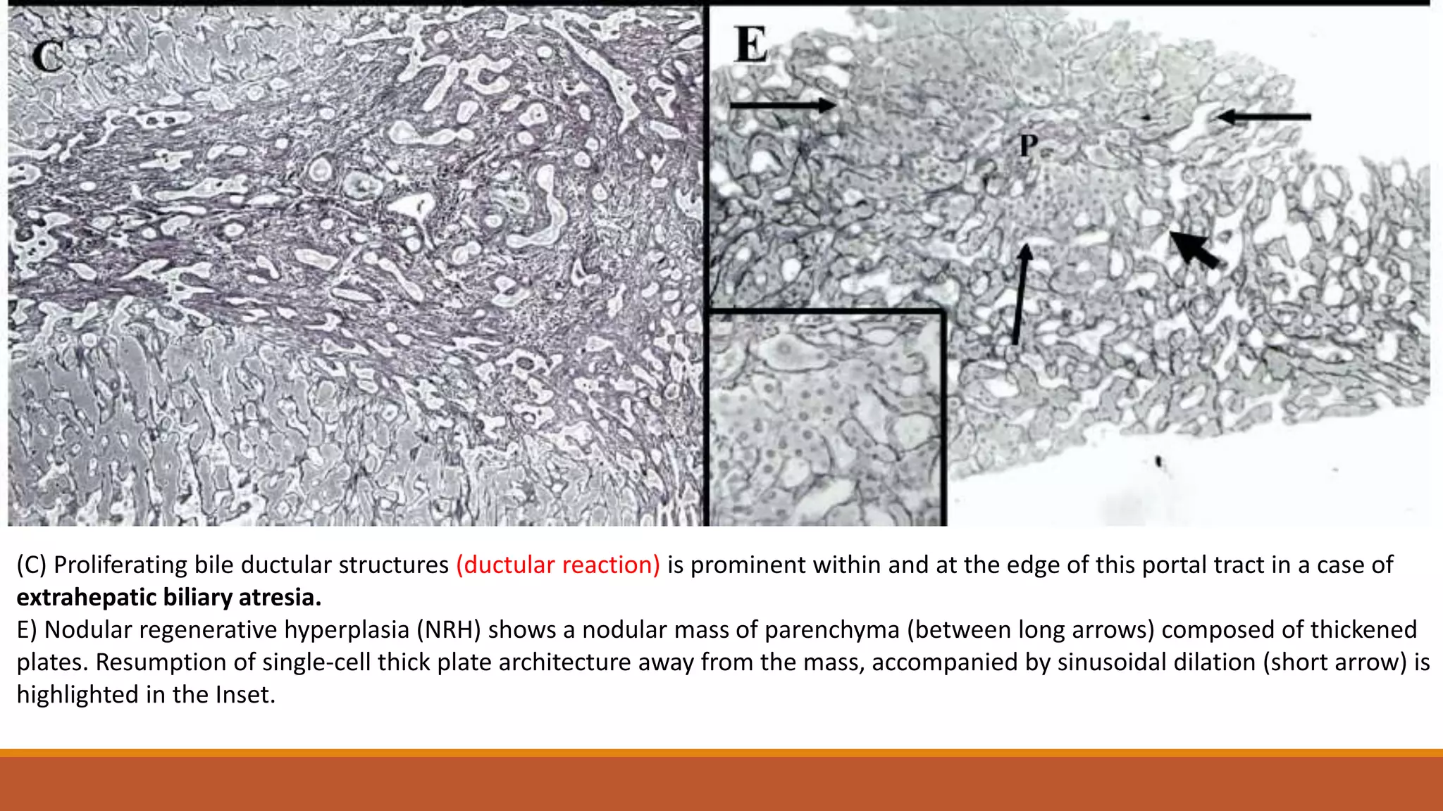 SPECIAL STAINS USED IN DIAGNOSING LIVER PATHOLOGY | PPTX