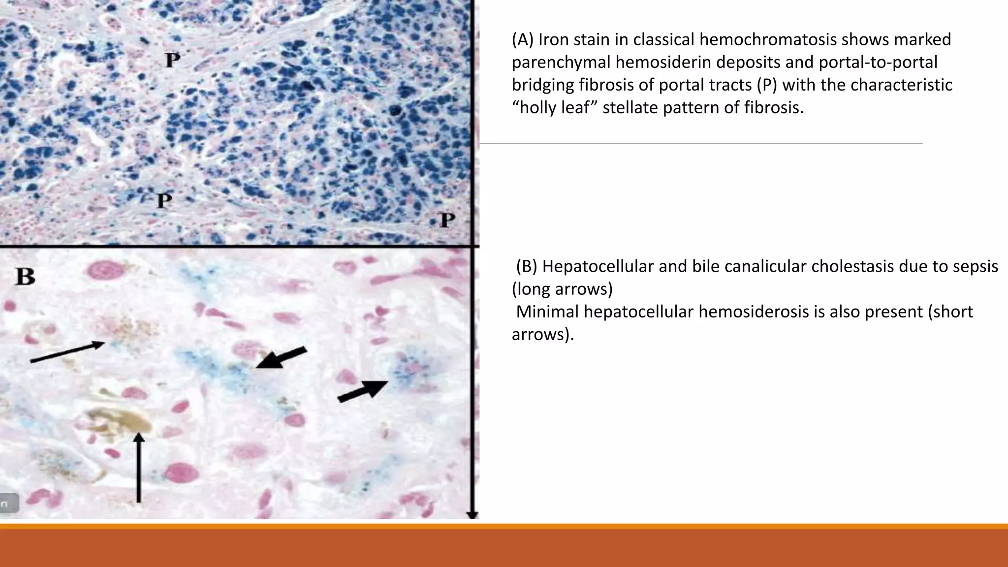 SPECIAL STAINS USED IN DIAGNOSING LIVER PATHOLOGY | PPTX