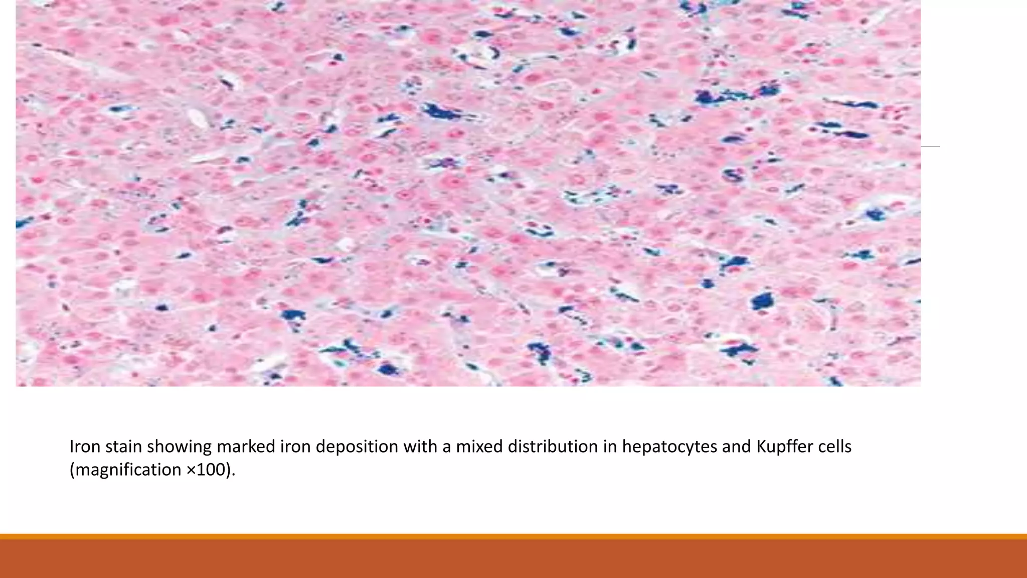 SPECIAL STAINS USED IN DIAGNOSING LIVER PATHOLOGY | PPTX