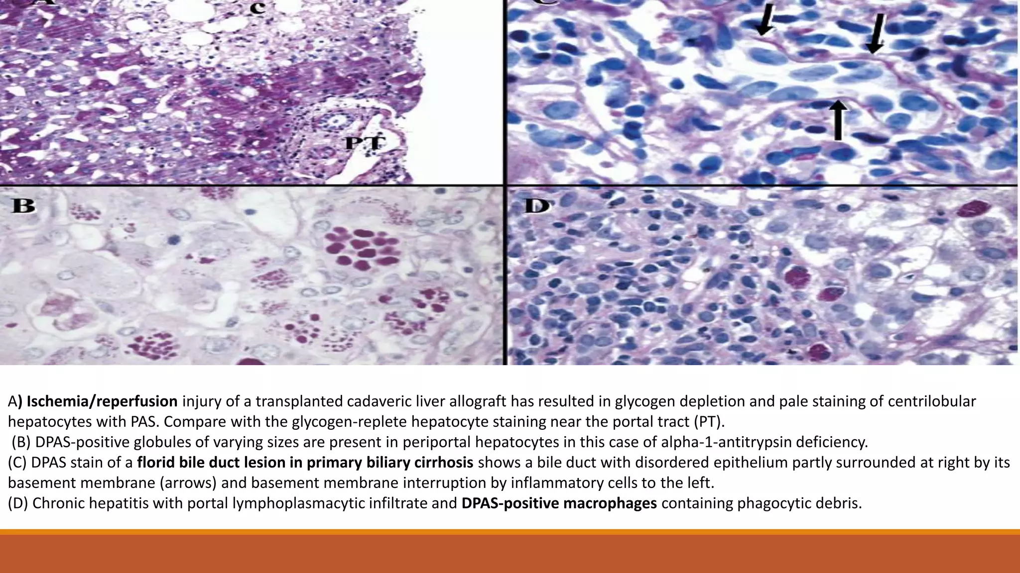 SPECIAL STAINS USED IN DIAGNOSING LIVER PATHOLOGY | PPTX