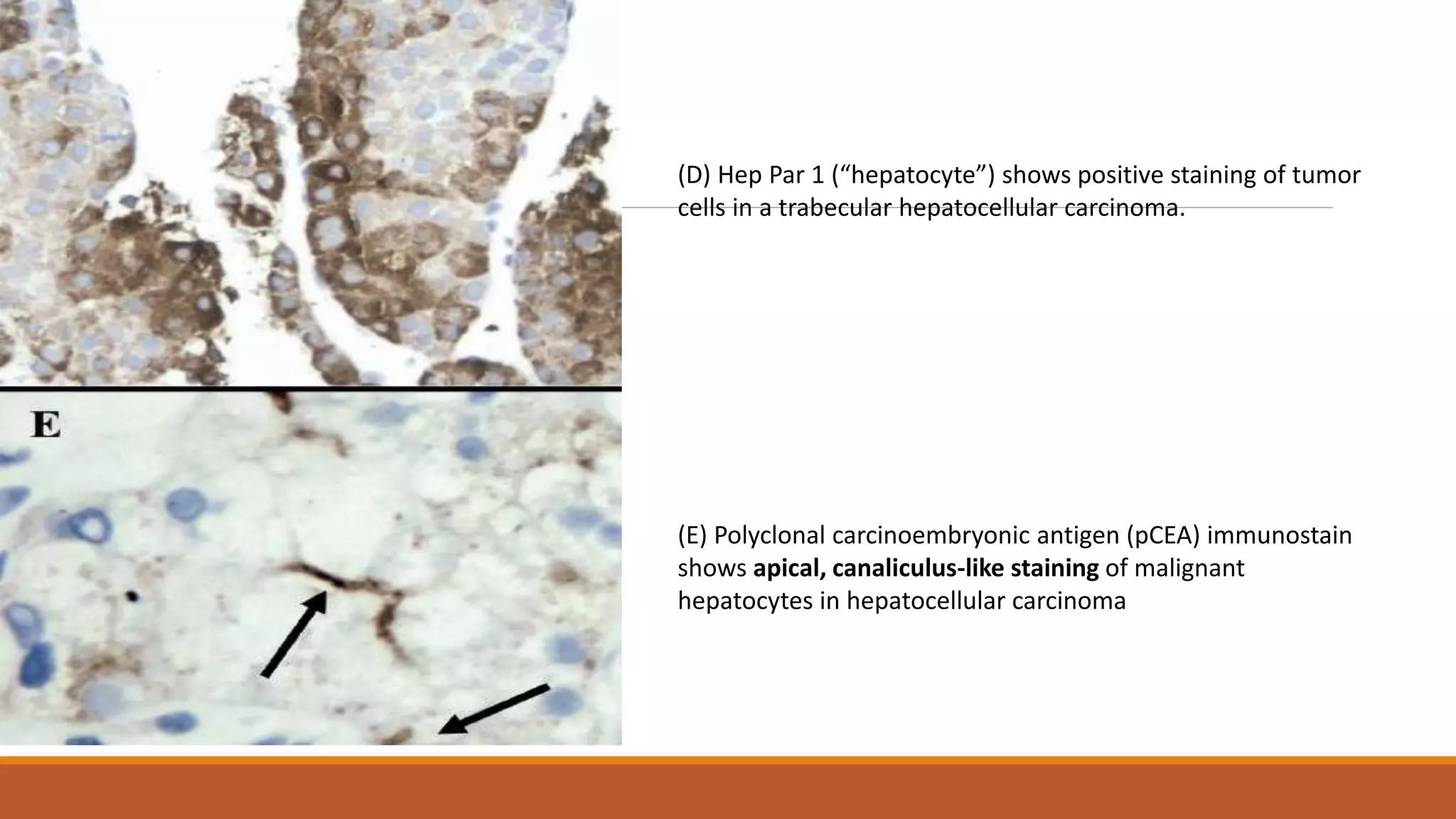 SPECIAL STAINS USED IN DIAGNOSING LIVER PATHOLOGY | PPTX