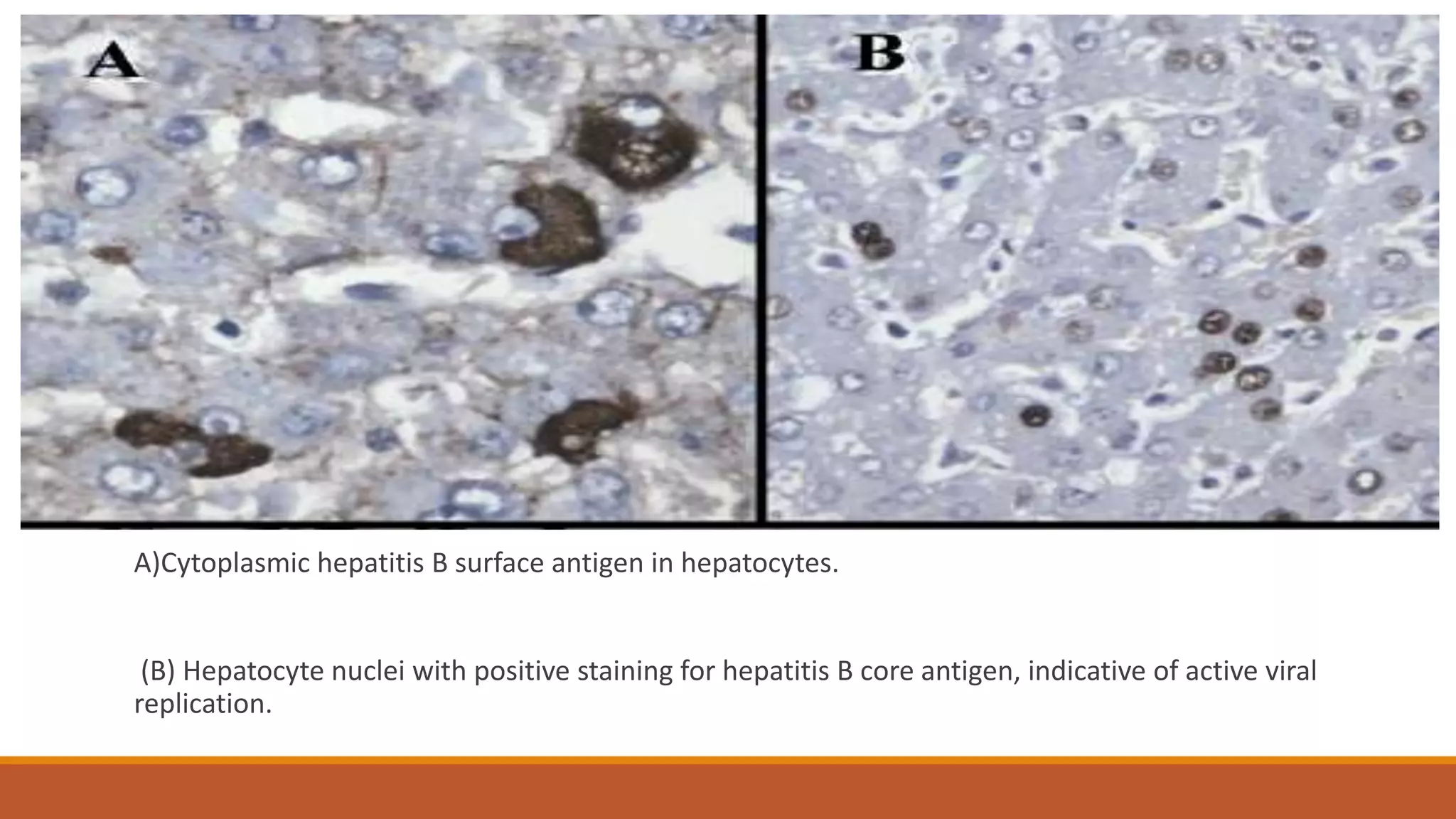 SPECIAL STAINS USED IN DIAGNOSING LIVER PATHOLOGY | PPTX