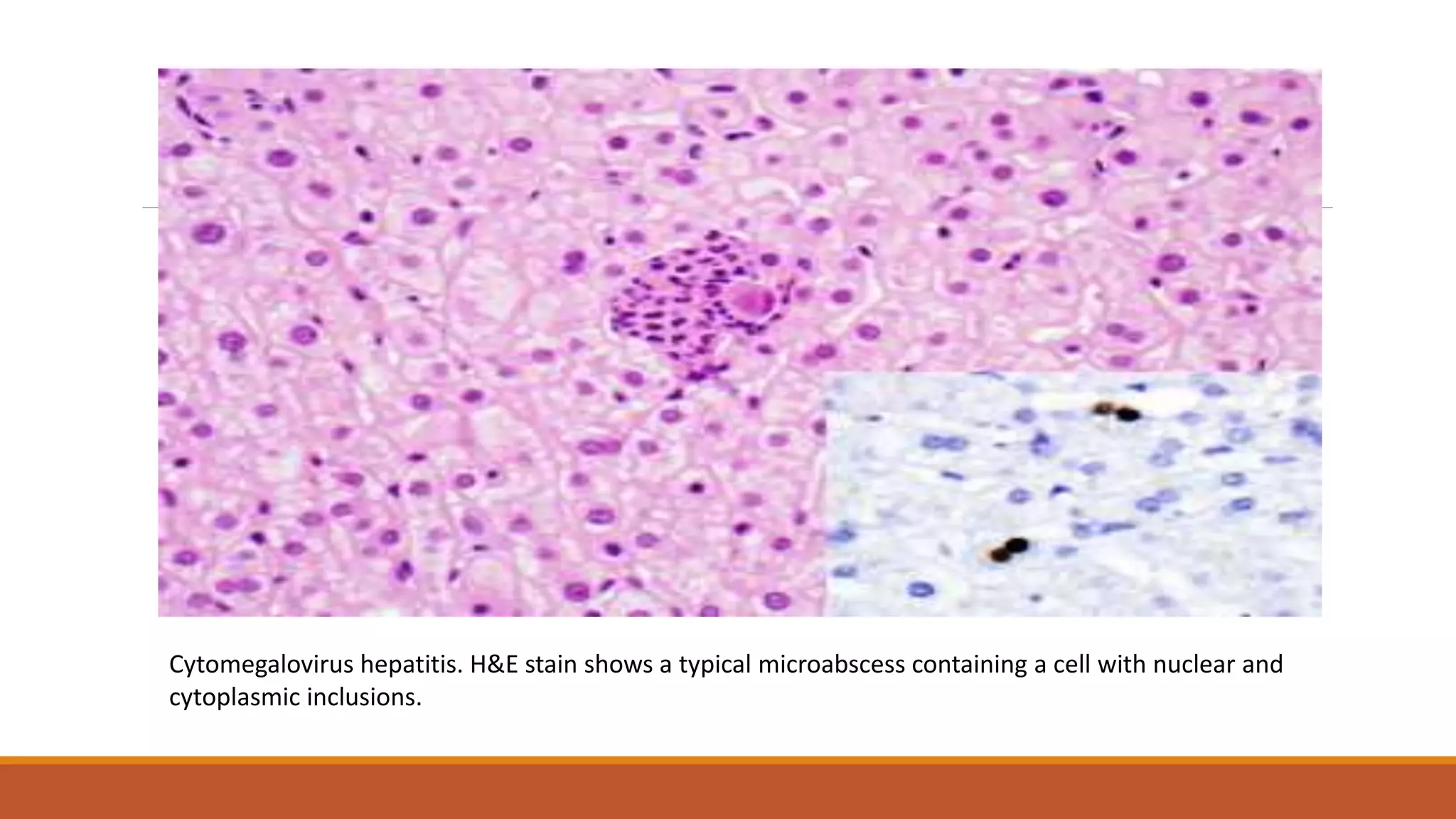SPECIAL STAINS USED IN DIAGNOSING LIVER PATHOLOGY | PPTX