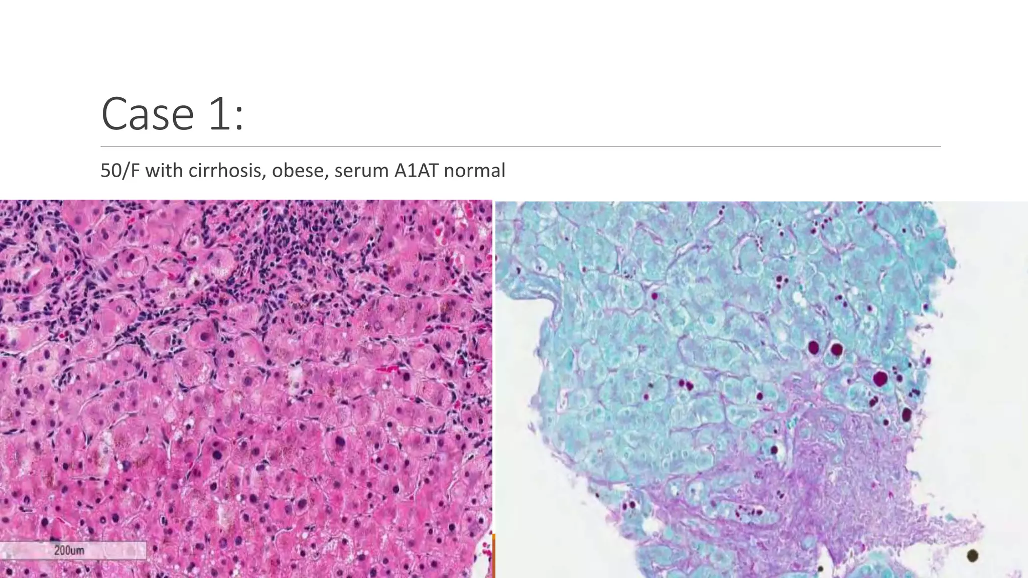 SPECIAL STAINS USED IN DIAGNOSING LIVER PATHOLOGY | PPTX