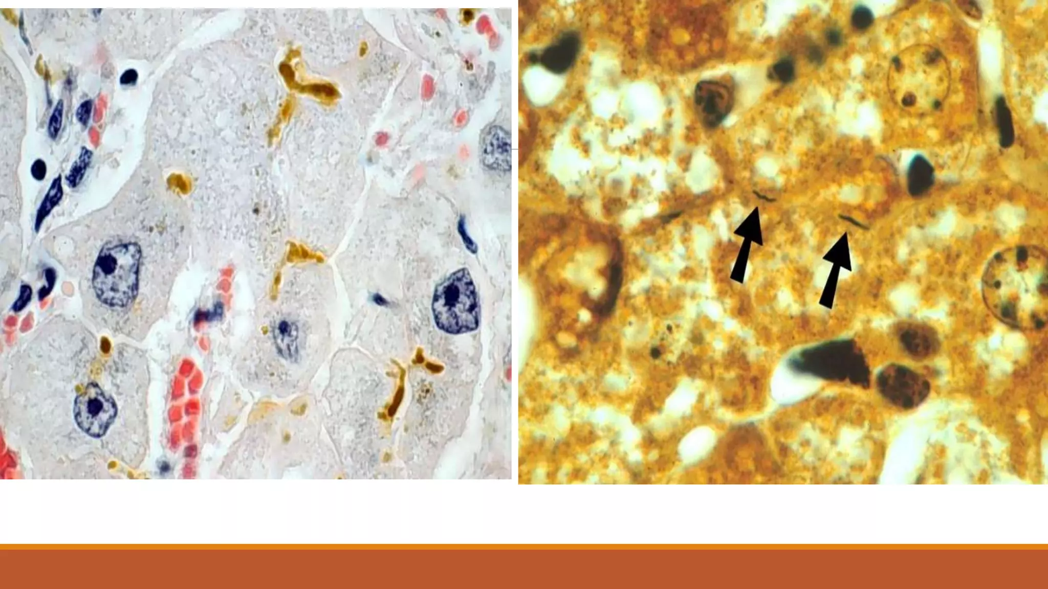 SPECIAL STAINS USED IN DIAGNOSING LIVER PATHOLOGY | PPTX