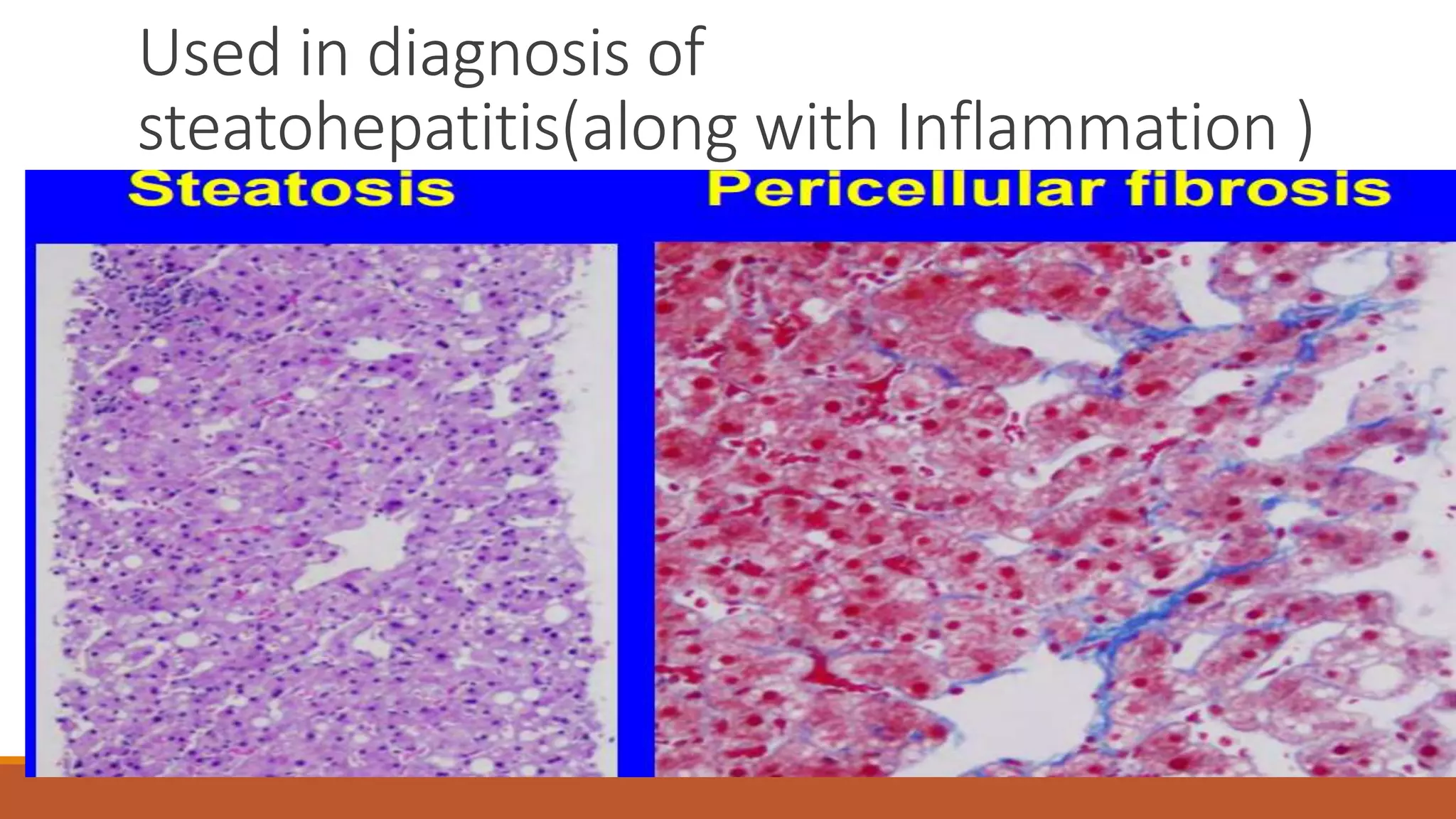 SPECIAL STAINS USED IN DIAGNOSING LIVER PATHOLOGY | PPTX
