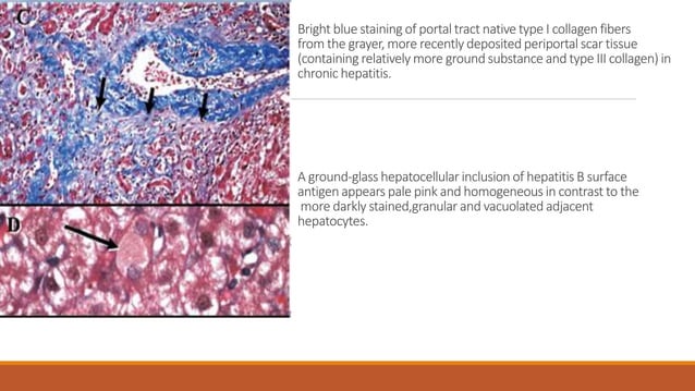 SPECIAL STAINS USED IN DIAGNOSING LIVER PATHOLOGY | PPTX | Blood ...