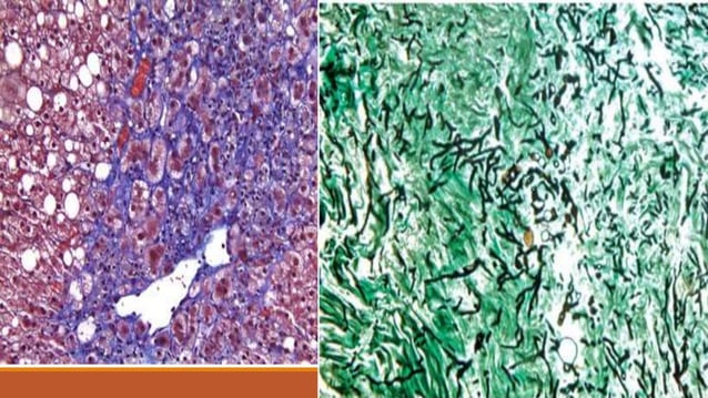 SPECIAL STAINS USED IN DIAGNOSING LIVER PATHOLOGY | PPTX | Blood ...
