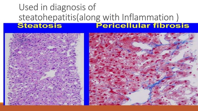 SPECIAL STAINS USED IN DIAGNOSING LIVER PATHOLOGY | PPTX | Blood ...