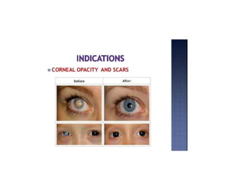 Special type of contact lens | PPTX