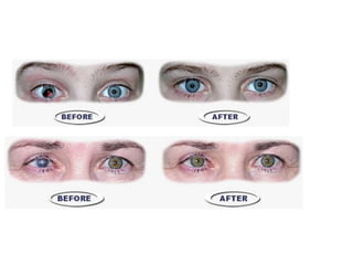 Special type of contact lens | PPTX