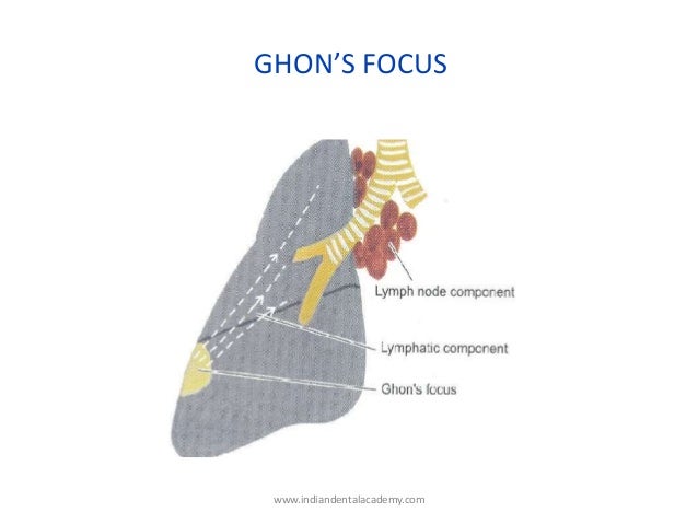 Specific bacterial infections /prosthodontic courses