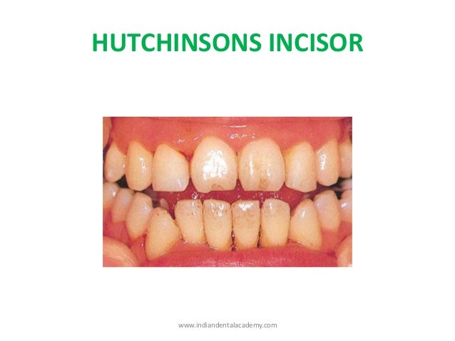 Specific bacterial infections /prosthodontic courses