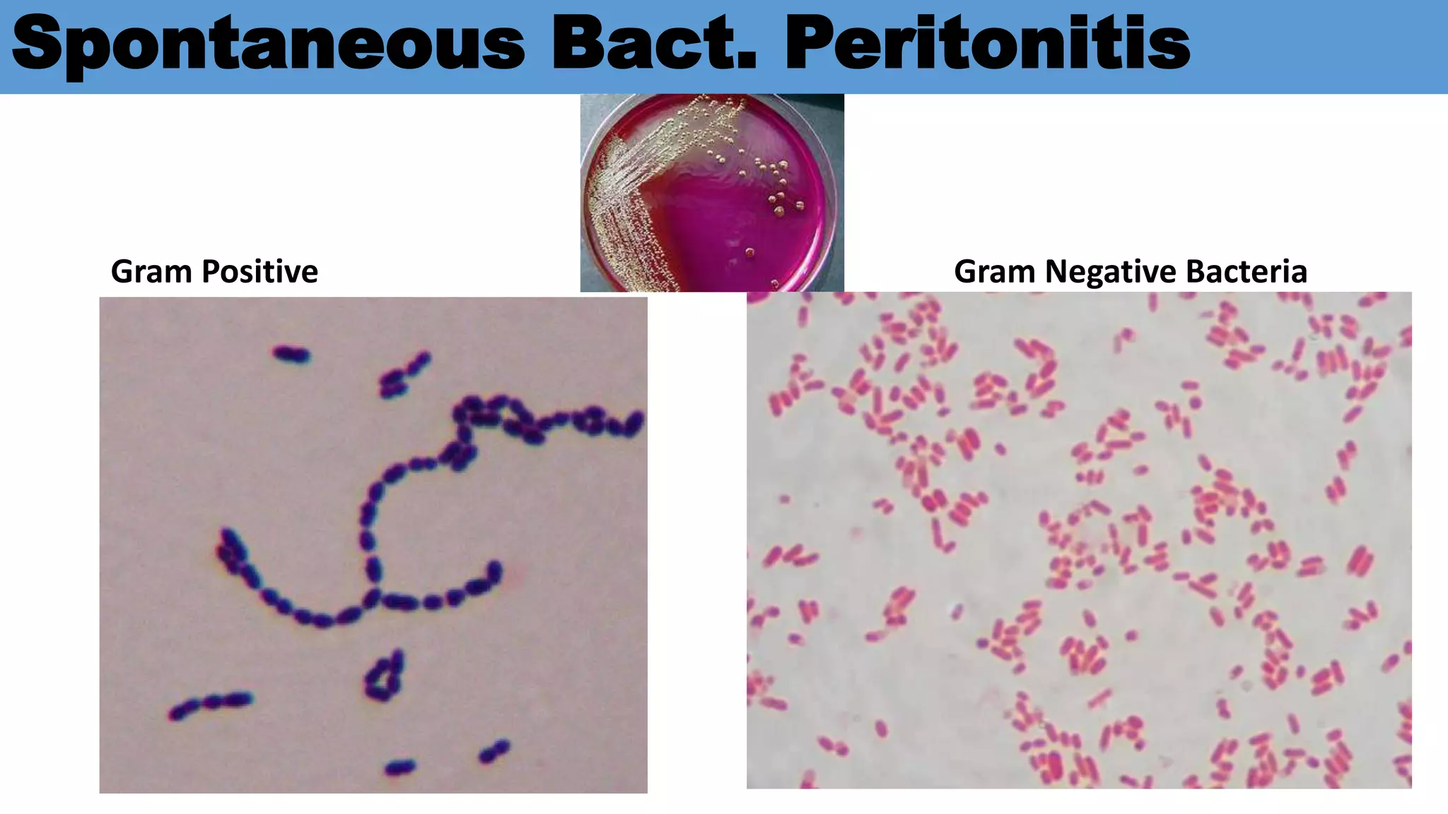 Specific causes of peritonitis | PPTX