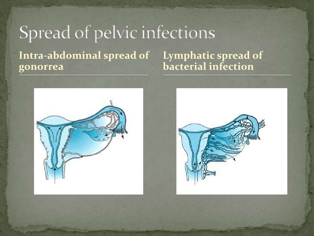 Specific inflammatory diseases of female reproductive system