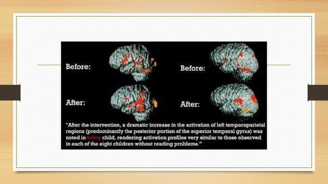 Specific learning disorder | PPT | Brain and Nervous System Disorders ...