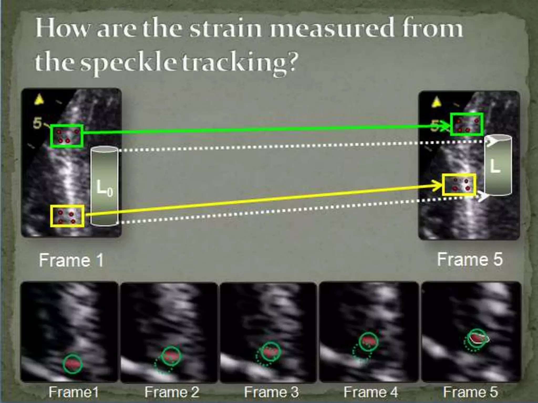 Speckle Tracking Echocardiography | PPT Speckle Tracking Echocardiography | PPT