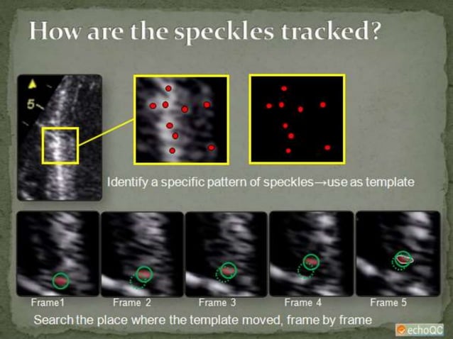 Speckle Tracking Echocardiography | PPTX