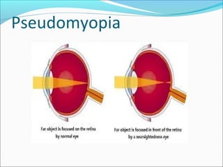 Spectacle prescription | PPT