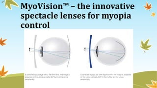 Spectacles for children | PPTX